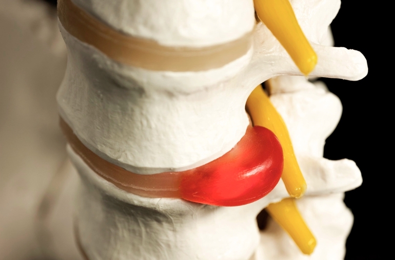 Slipped Disc | Symptoms & Treatment | Ortho Spineworks