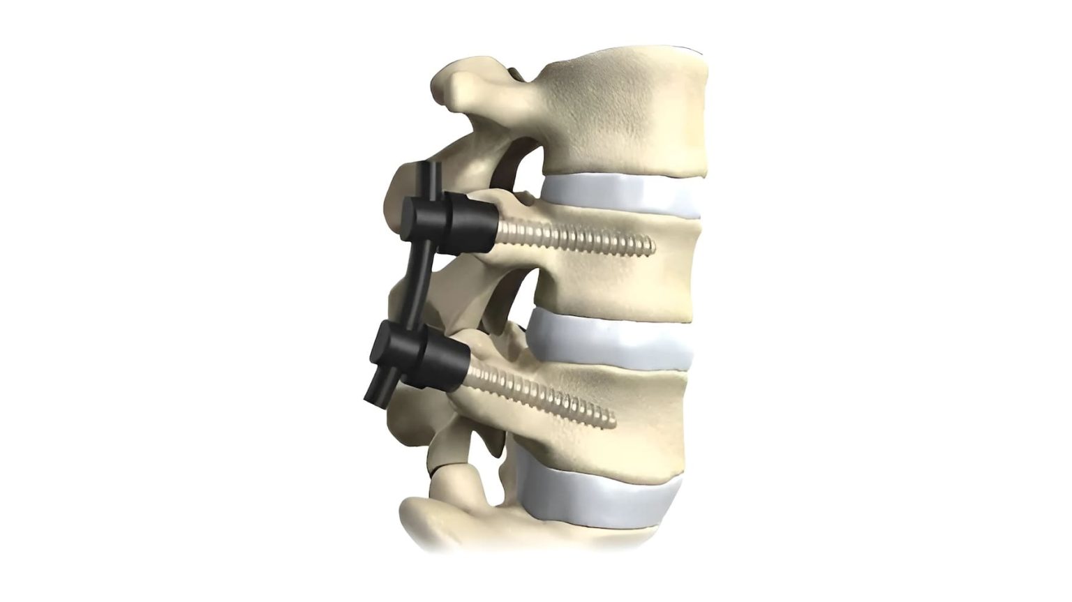 Spinal Tumour Surgery: Stabilising T4 Fractures with Carbon Fibre ...